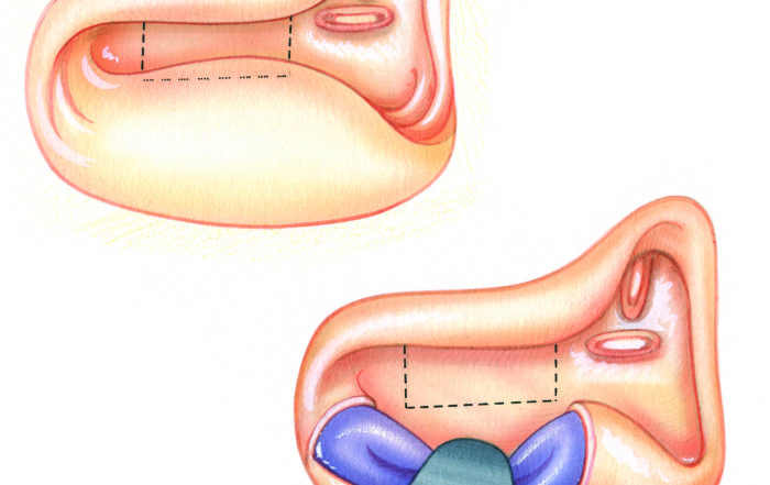 Endolymphatic Sac Surgery – Oto Surgery Atlas