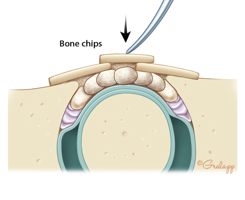 Superior Semicircular Canal Dehiscence – Oto Surgery Atlas