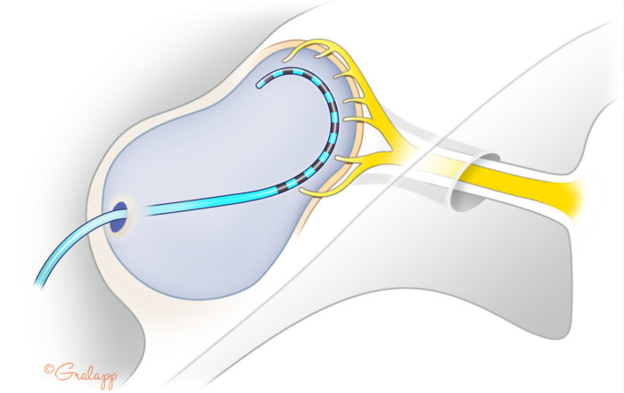Cochlear Implant Surgical Variations – Oto Surgery Atlas