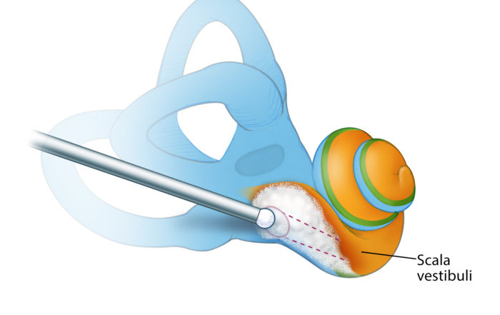 Cochlear Implant Surgical Variations – Oto Surgery Atlas