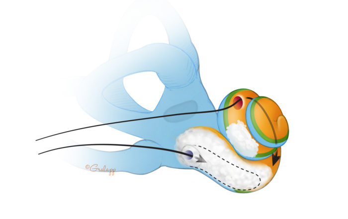 Cochlear Implant Surgical Variations – Oto Surgery Atlas