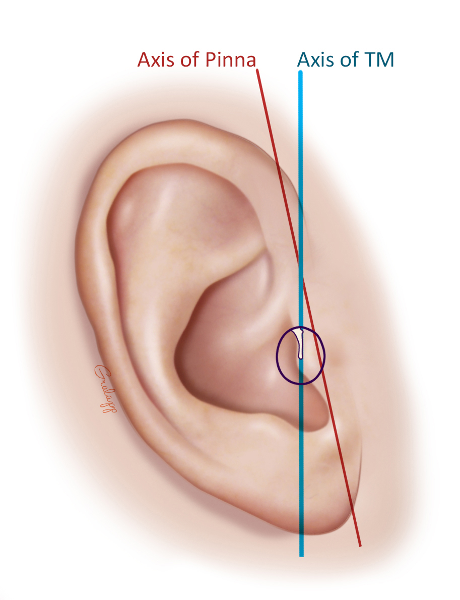 External Ear Oto Surgery Atlas External Ear Oto Surgery Atlas