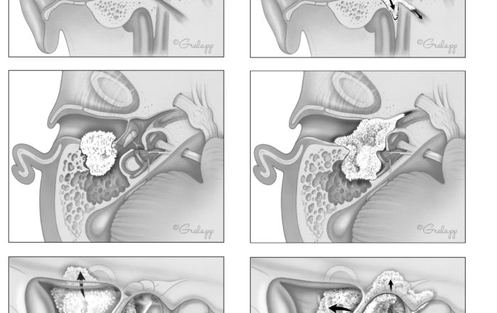 Ear Tumor Anatomy – Oto Surgery Atlas