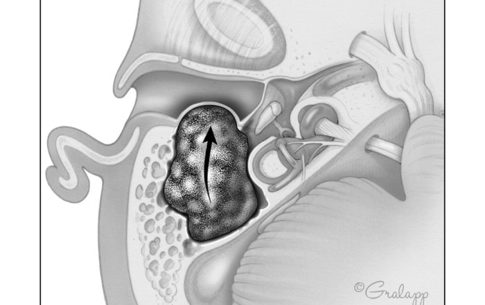 Ear Tumor Anatomy – Oto Surgery Atlas