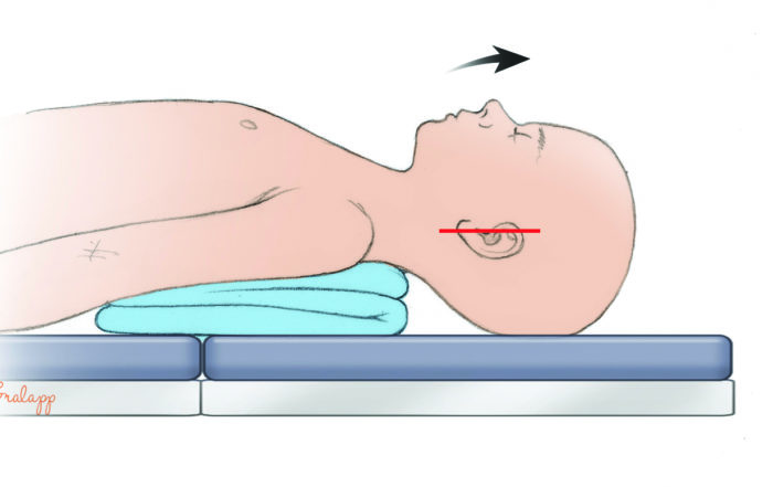 Patient Positioning – Oto Surgery Atlas