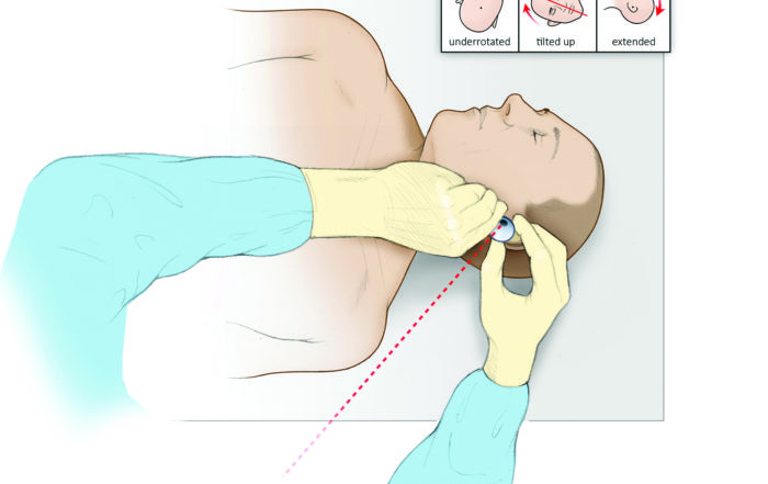 Patient Positioning – Oto Surgery Atlas