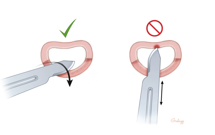Postauricular Canal Flap Design – Oto Surgery Atlas