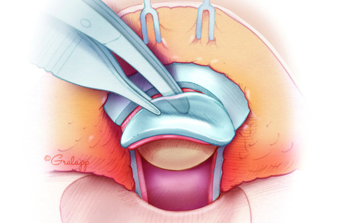 Postauricular Meatoplasty – Oto Surgery Atlas