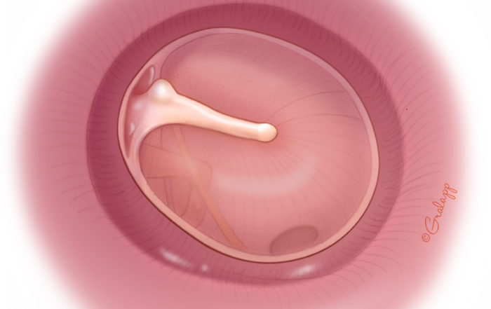 Exostoses of the Ear Canal – Oto Surgery Atlas