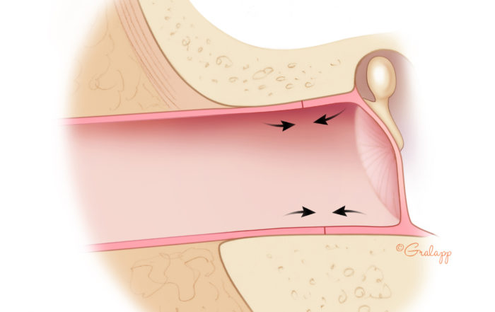 Exostoses of the Ear Canal – Oto Surgery Atlas