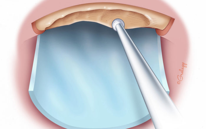 Anterior Canalplasty – Oto Surgery Atlas