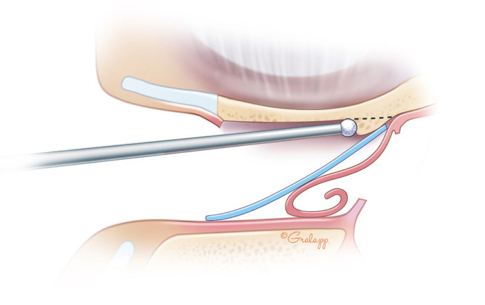 Anterior Canalplasty – Oto Surgery Atlas