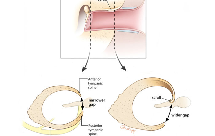 Anterior Canalplasty – Oto Surgery Atlas