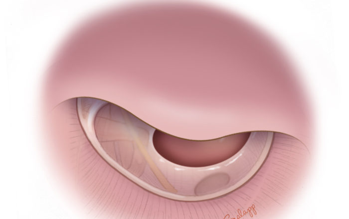 Anterior Canalplasty – Oto Surgery Atlas