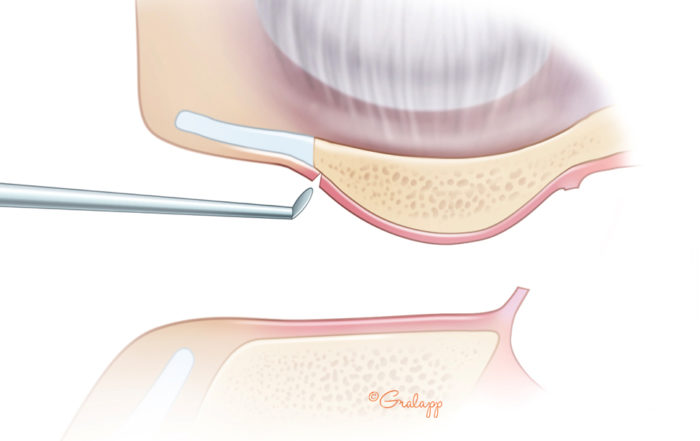 Anterior Canalplasty – Oto Surgery Atlas