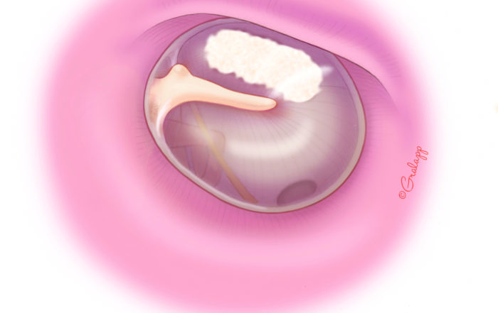 Tympanosclerosis – Oto Surgery Atlas