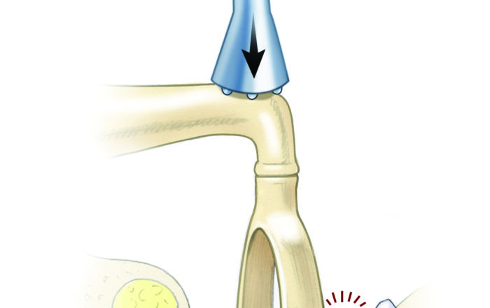 Tympanosclerosis – Oto Surgery Atlas
