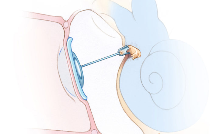 Prosthetic Ossiculoplasty – Oto Surgery Atlas