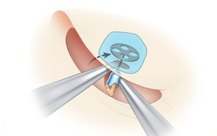 Trans-facial Recess Ossiculoplasty – Oto Surgery Atlas