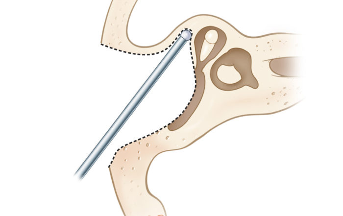 Anatomical Variation in Mastoidectomy – Oto Surgery Atlas