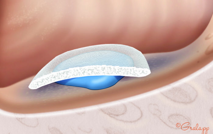 Complications of Mastoidectomy – Oto Surgery Atlas