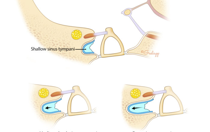 Sinus Tympani & Facial Recess in Cholesteatoma – Oto Surgery Atlas