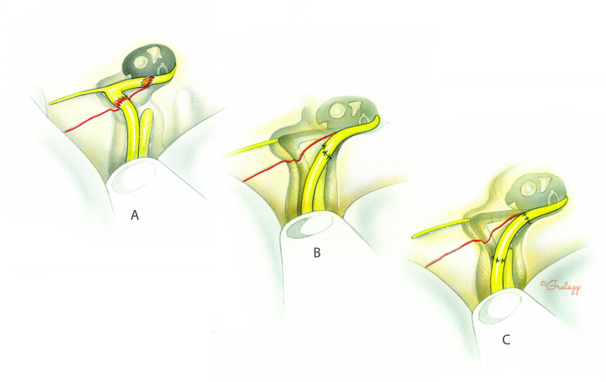 Repair of the Facial Nerve – Oto Surgery Atlas