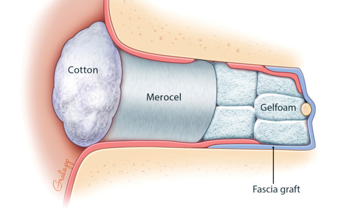 Lateral Graft Tympanoplasty – Oto Surgery Atlas